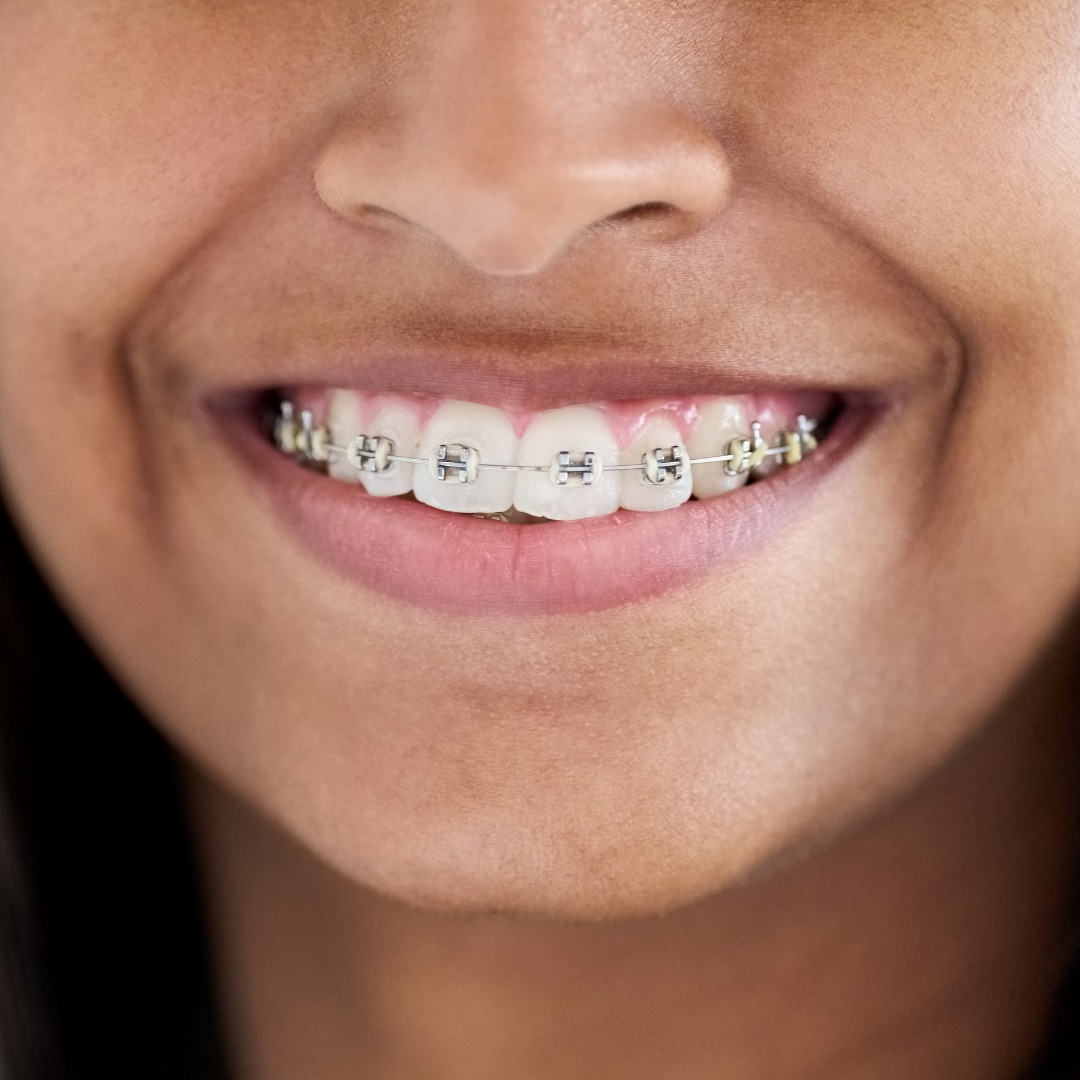 Braces in Bridgeport, New Haven, & More | CT Braces